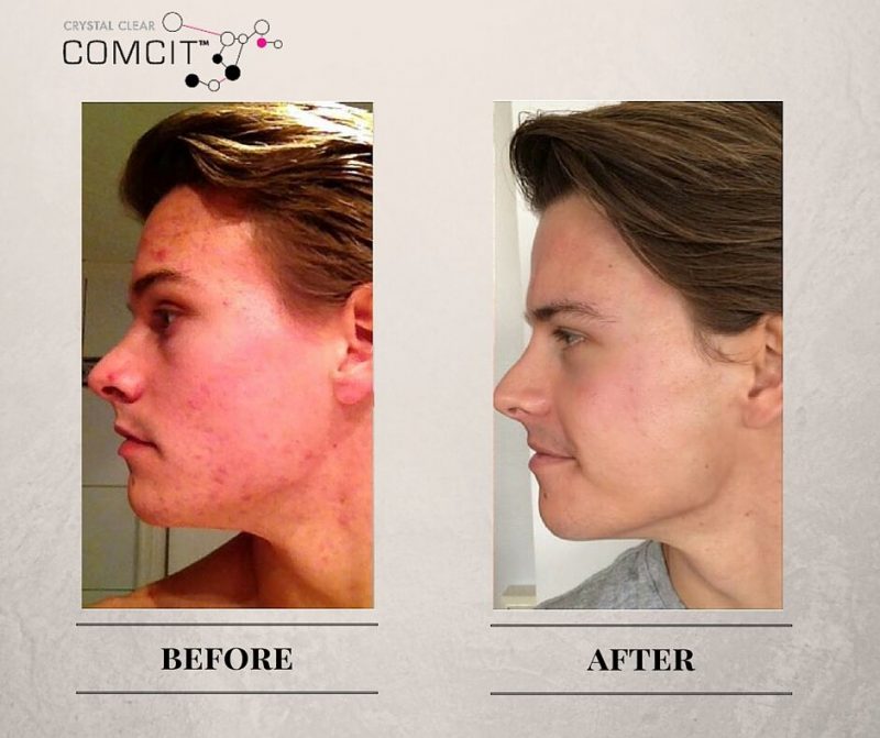 COMCIT Microneedling - skin rejuvenation - Lux Laser and Beauty Clinic